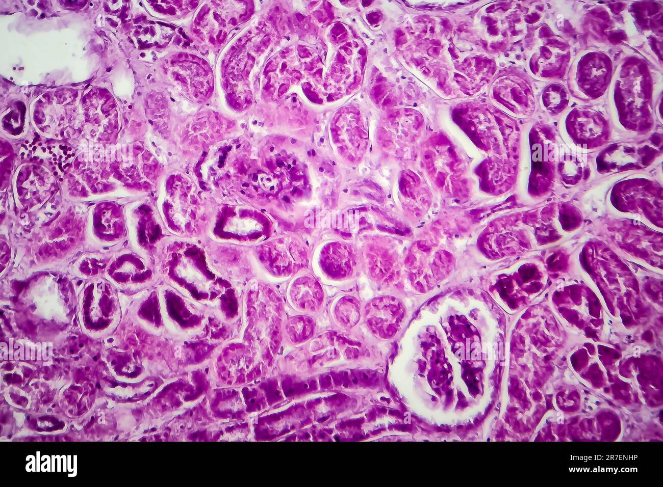 Glomerulonephritis. Light micrograph of tissue from a kidney in a case ...