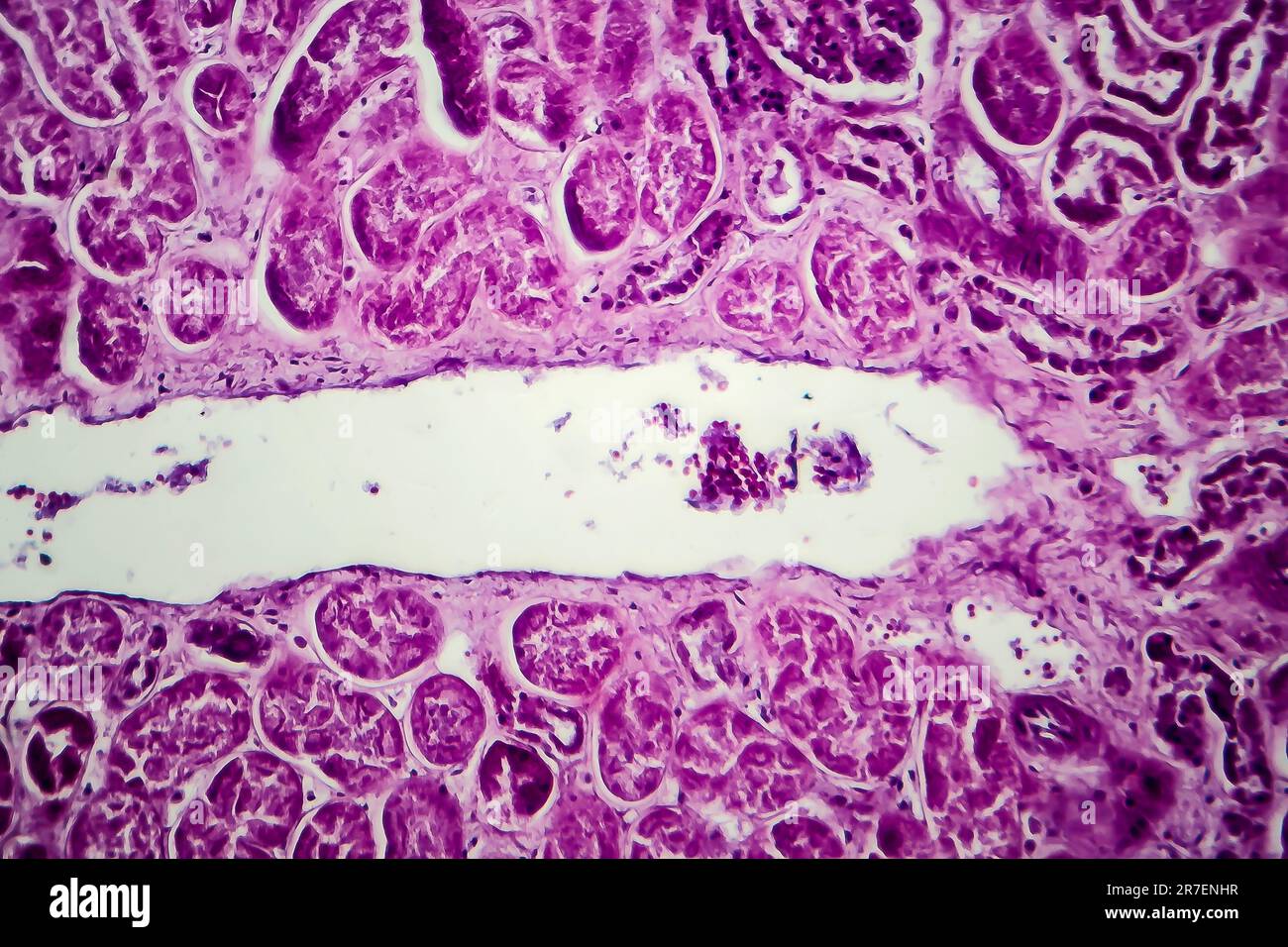 Glomerulonephritis. Light micrograph of tissue from a kidney in a case ...