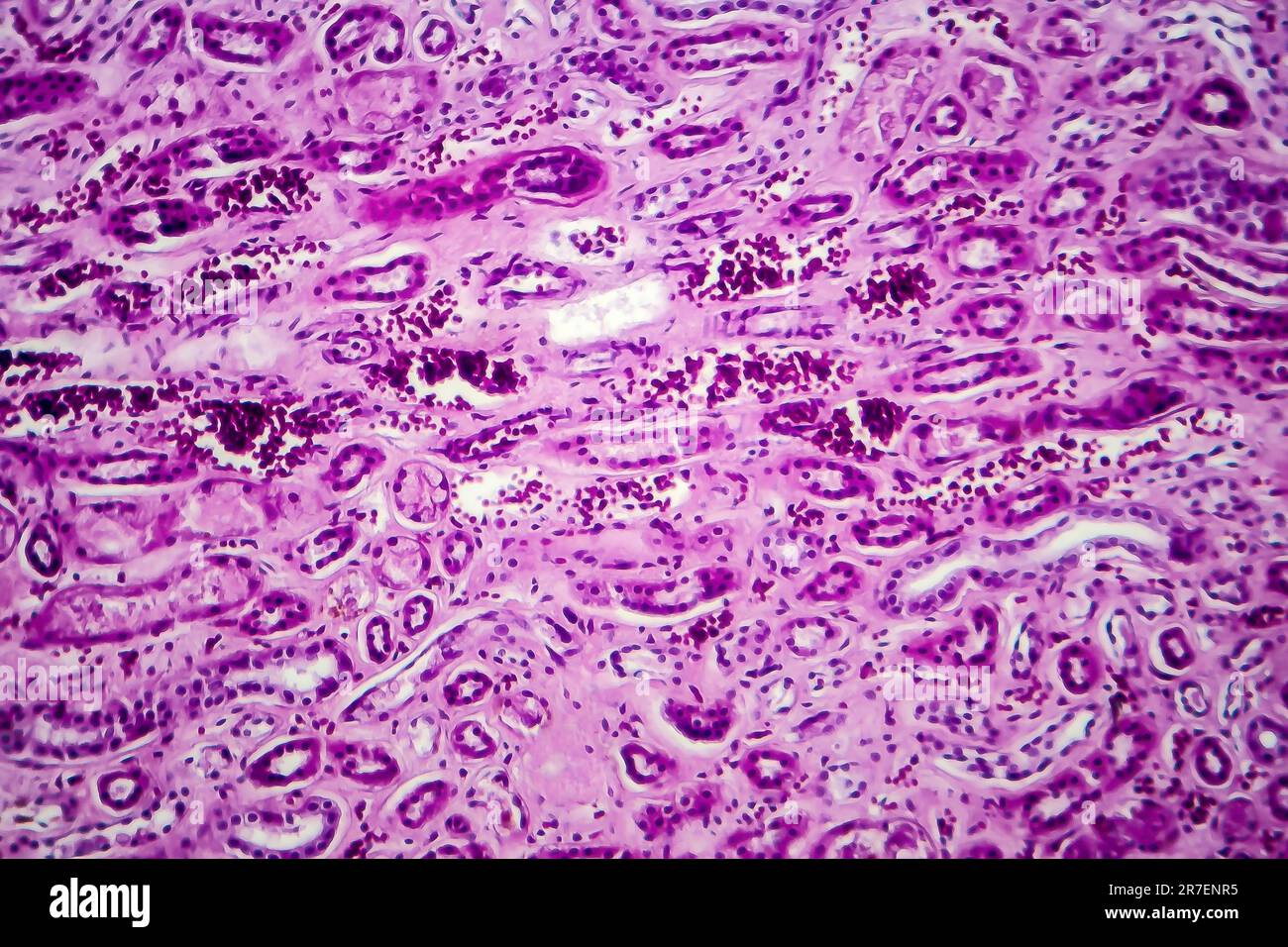 Glomerulonephritis. Light micrograph of tissue from a kidney in a case ...