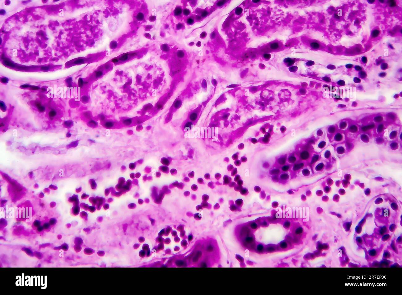 Glomerulonephritis. Light micrograph of tissue from a kidney in a case ...