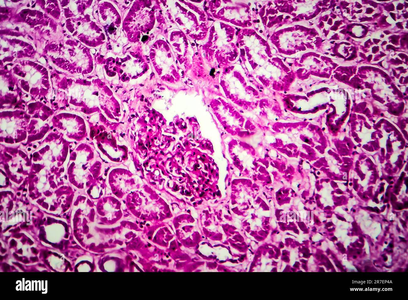 Glomerulonephritis. Light micrograph of tissue from a kidney in a case ...