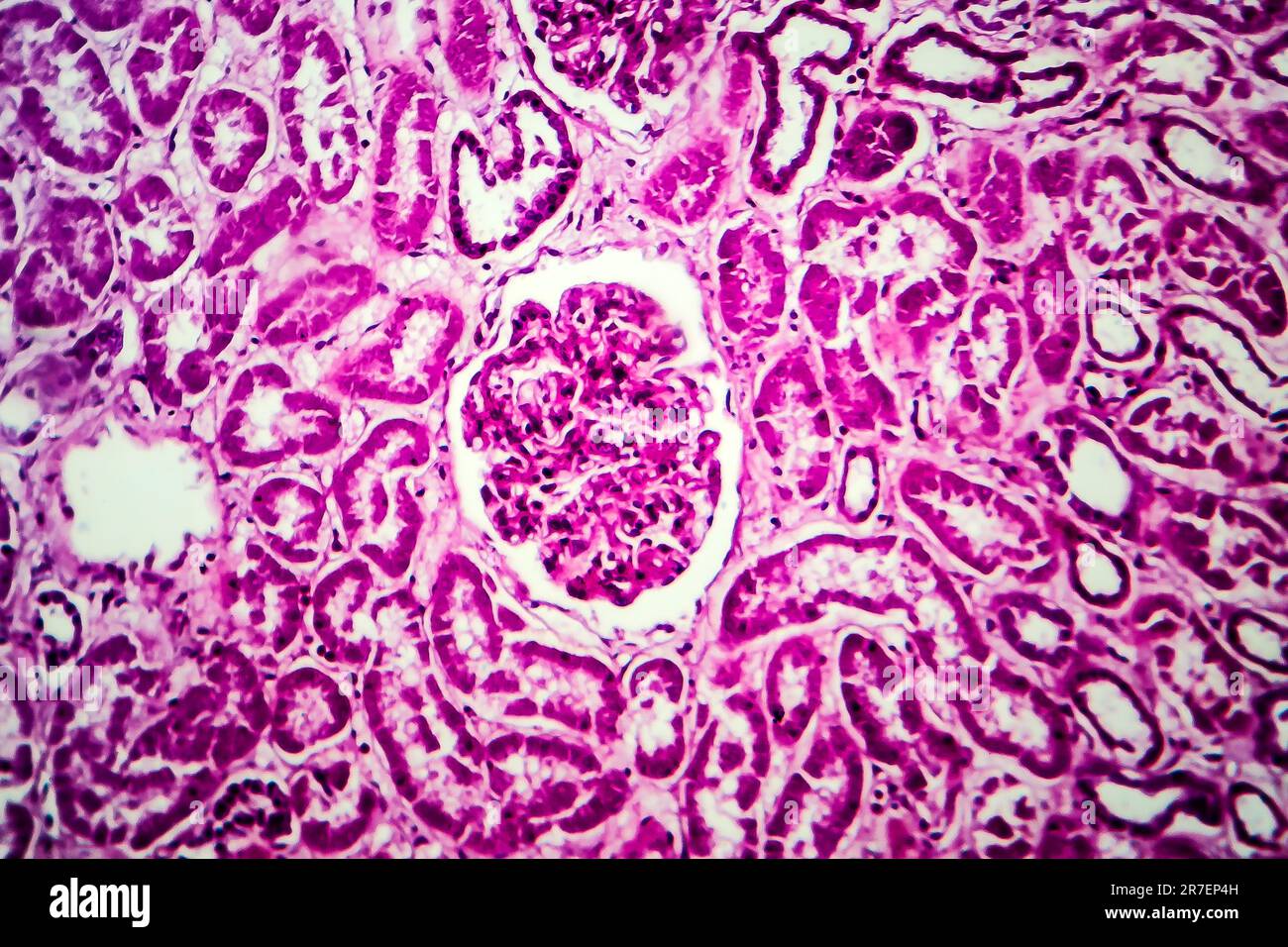 Glomerulonephritis. Light micrograph of tissue from a kidney in a case ...