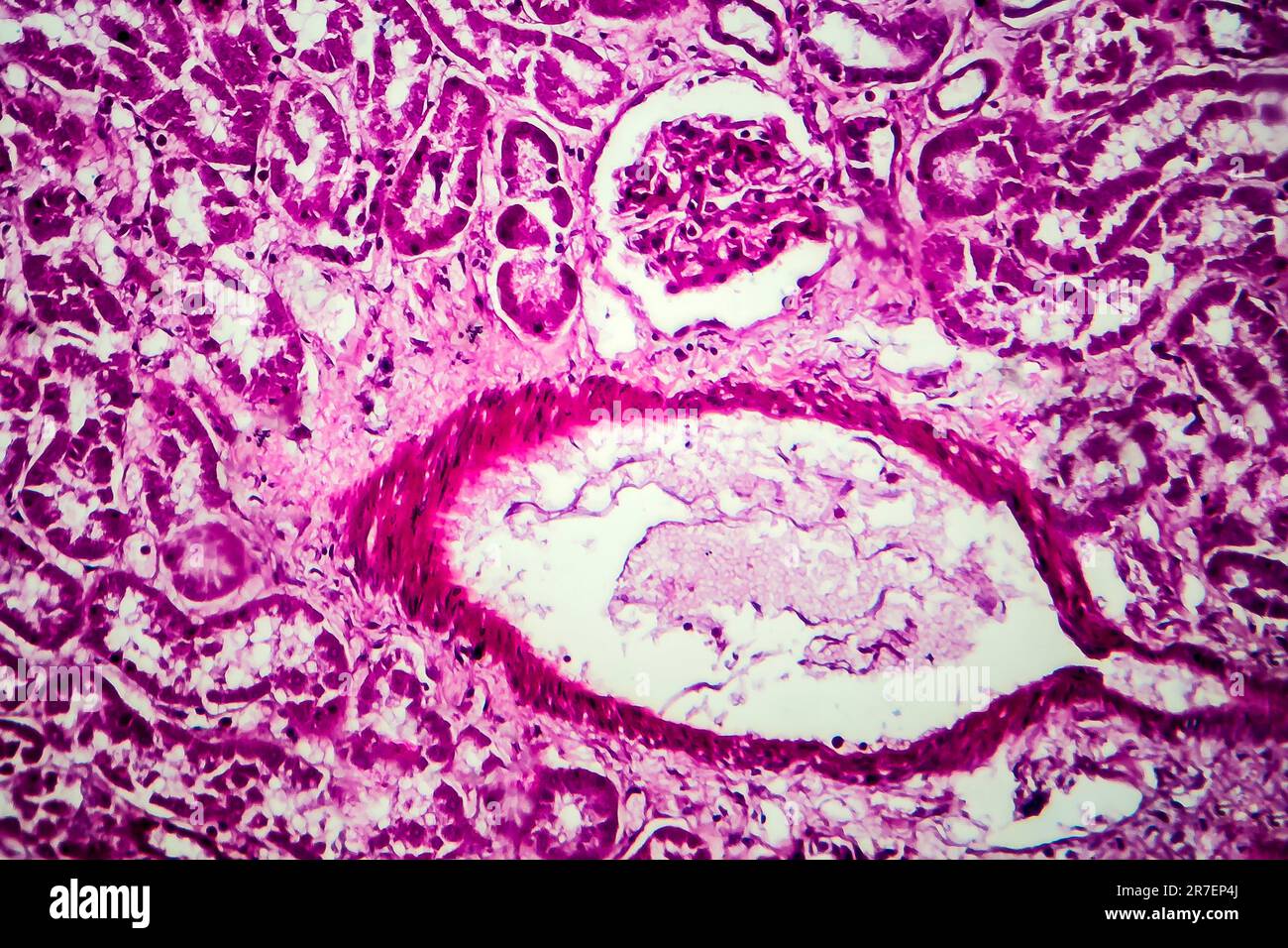 Glomerulonephritis. Light micrograph of tissue from a kidney in a case ...