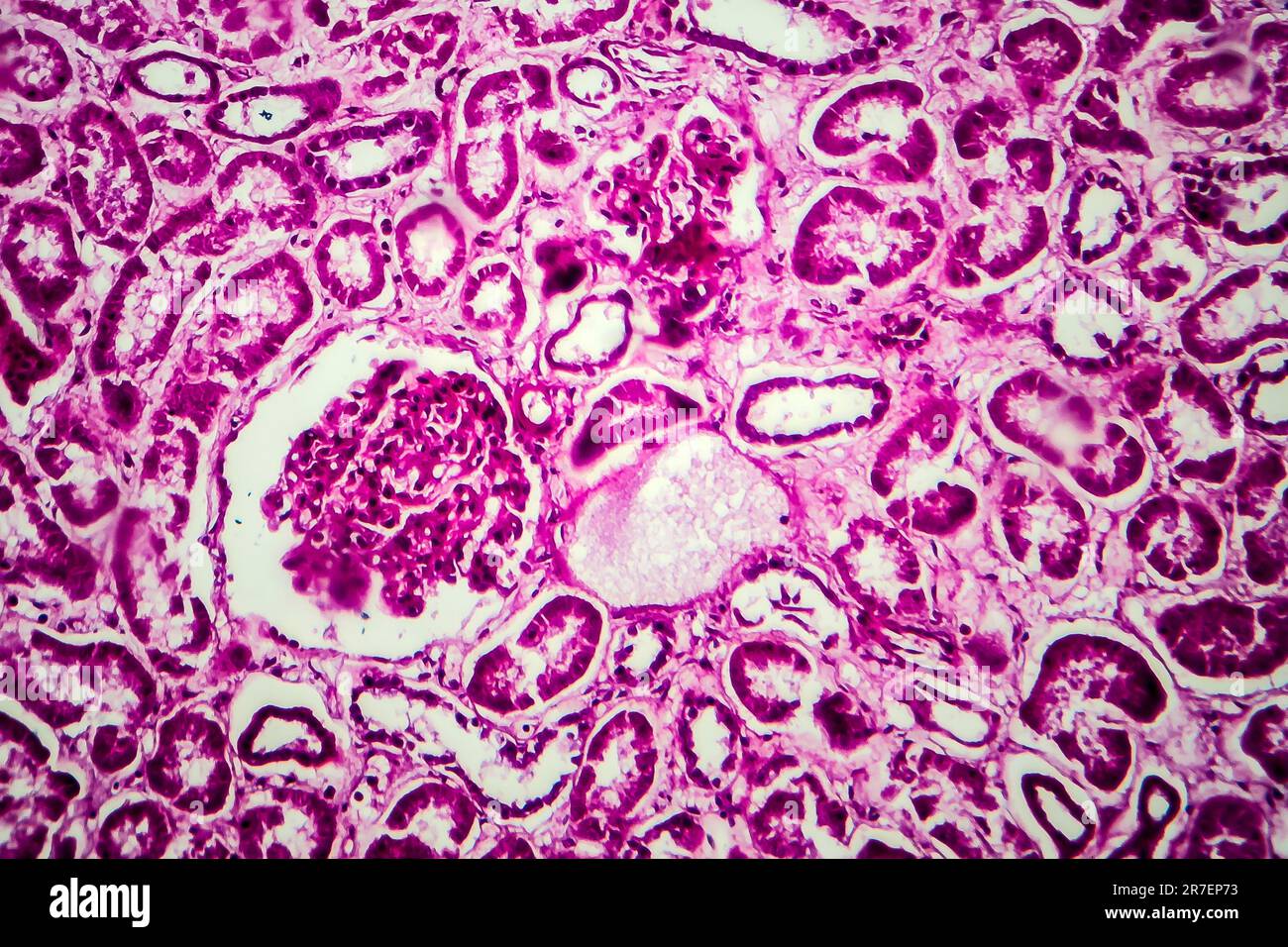 Glomerulonephritis. Light micrograph of tissue from a kidney in a case ...