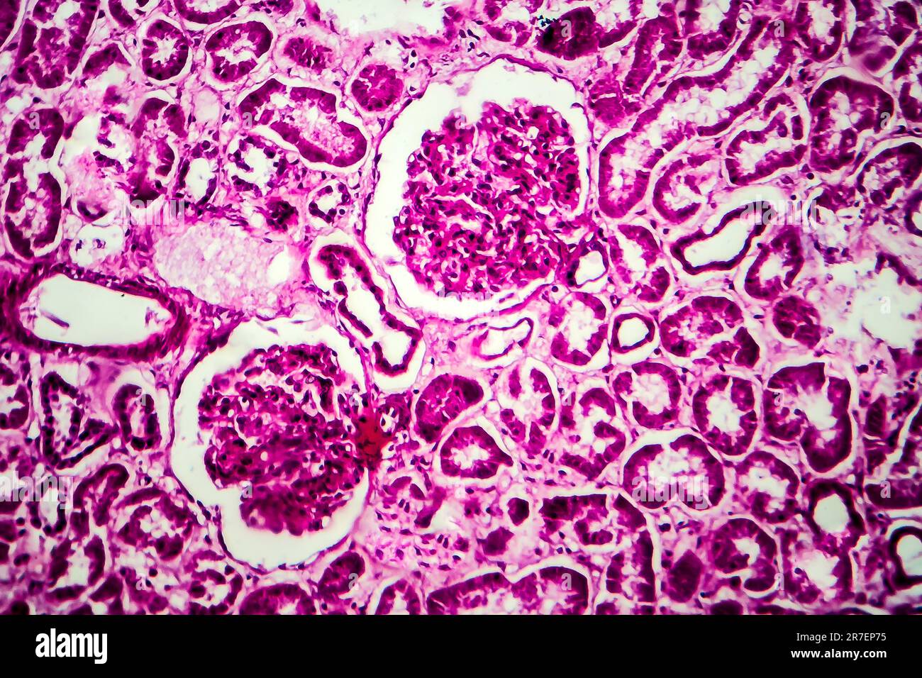Glomerulonephritis. Light micrograph of tissue from a kidney in a case ...