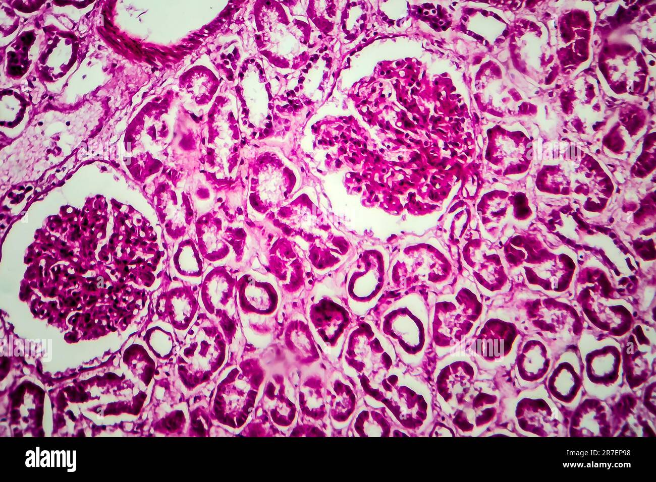 Glomerulonephritis. Light micrograph of tissue from a kidney in a case ...