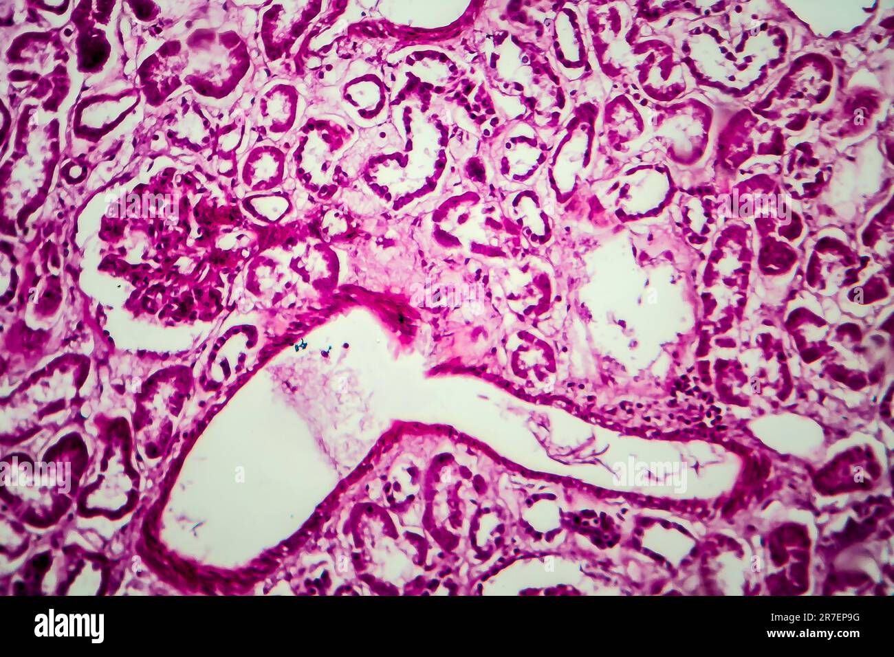 Glomerulonephritis. Light micrograph of tissue from a kidney in a case ...