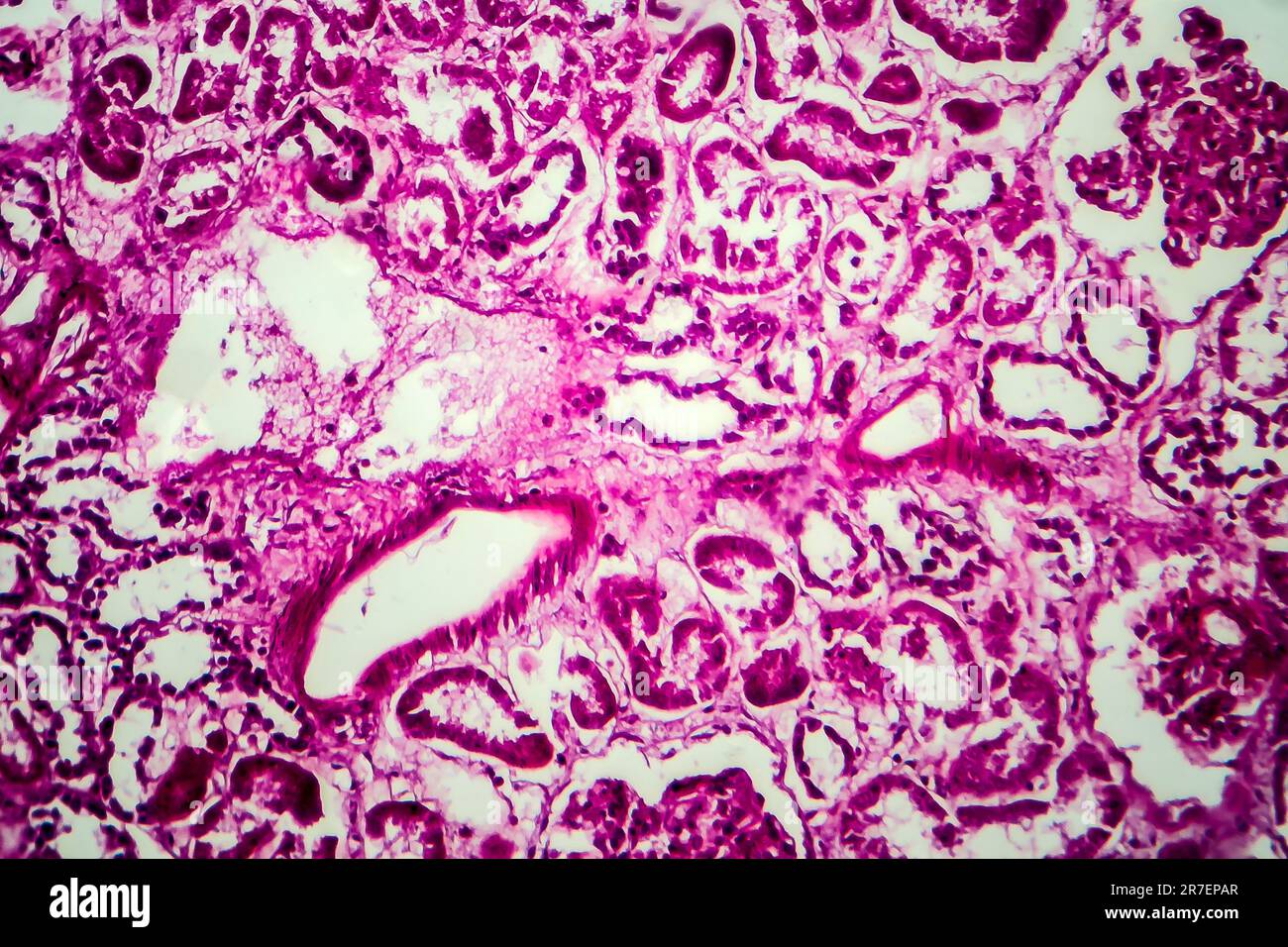 Glomerulonephritis. Light micrograph of tissue from a kidney in a case ...
