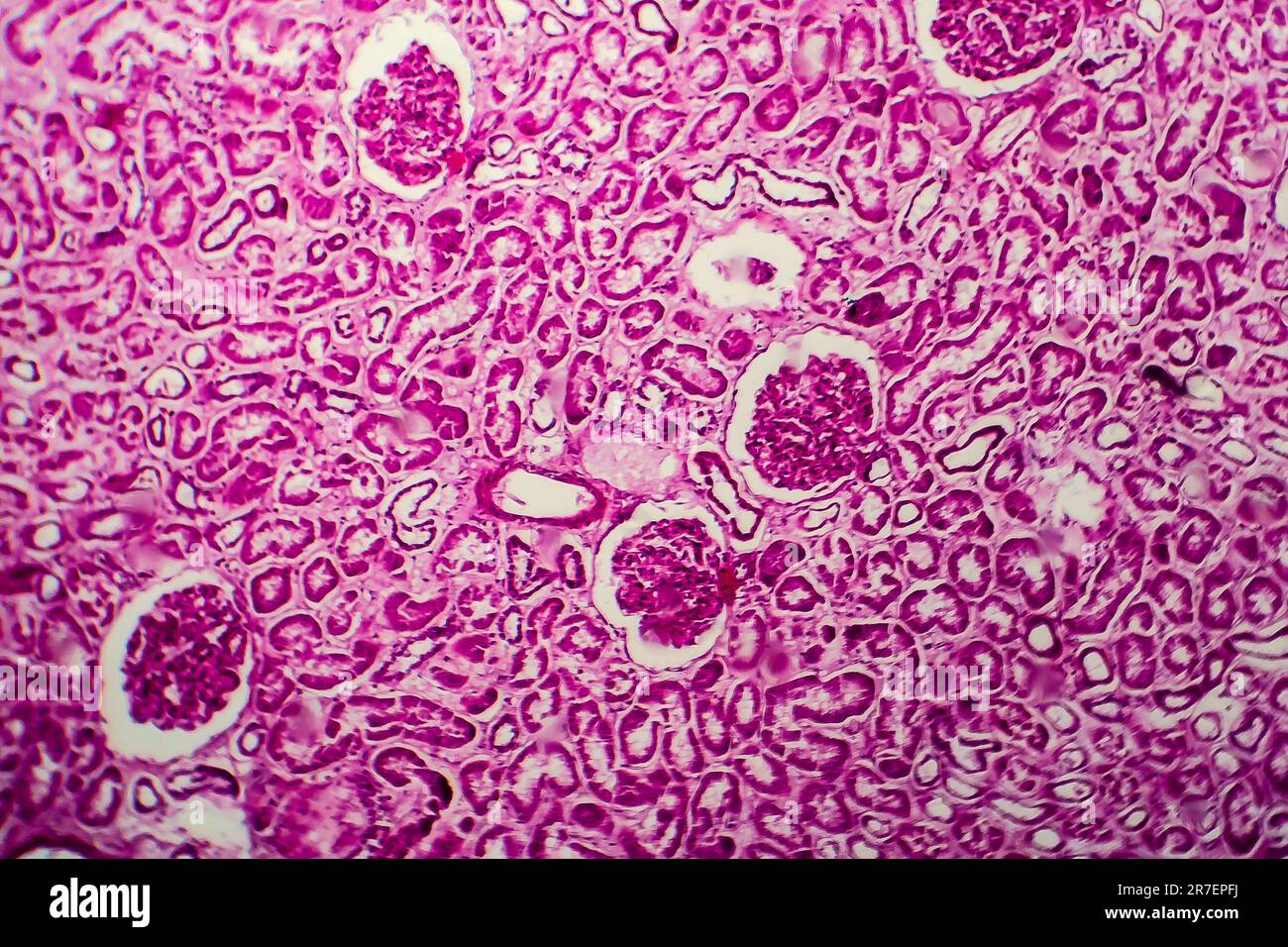Glomerulonephritis. Light micrograph of tissue from a kidney in a case ...