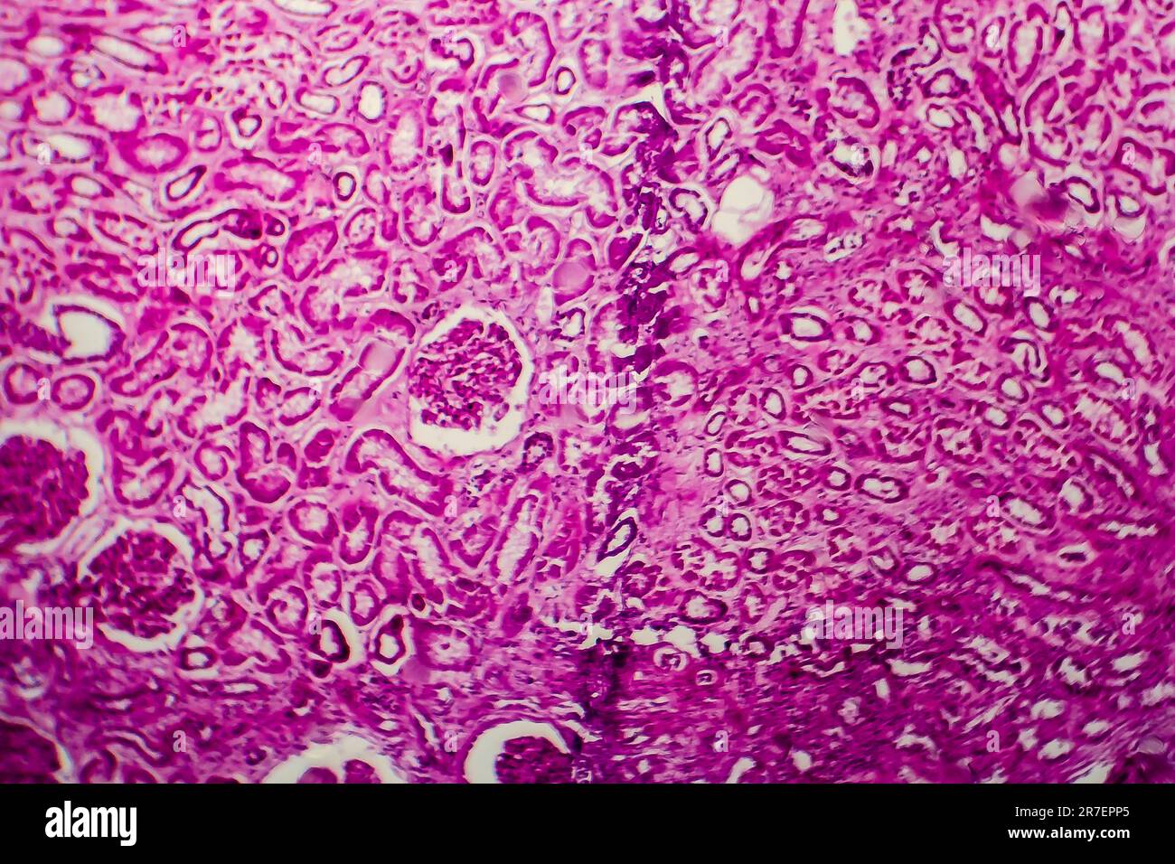 Glomerulonephritis. Light micrograph of tissue from a kidney in a case ...