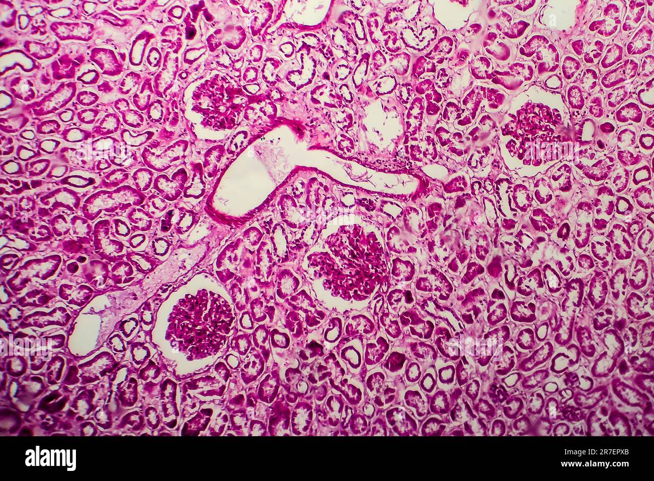 Glomerulonephritis. Light micrograph of tissue from a kidney in a case ...
