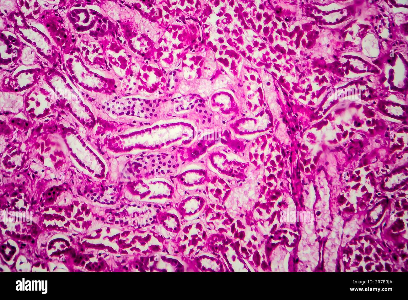 Glomerulonephritis. Light micrograph of tissue from a kidney in a case ...