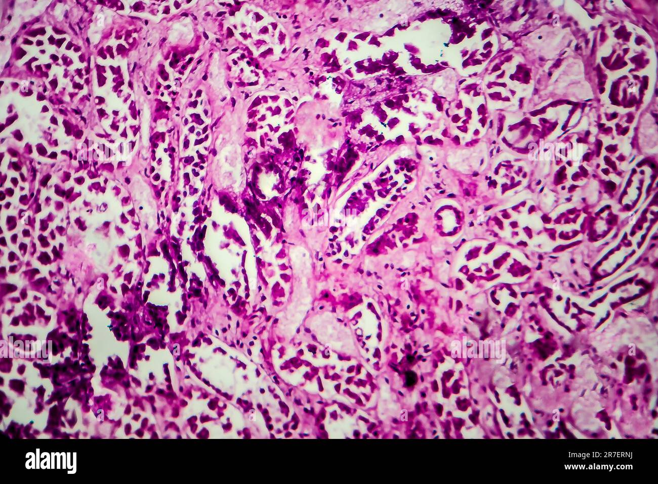Glomerulonephritis. Light micrograph of tissue from a kidney in a case ...