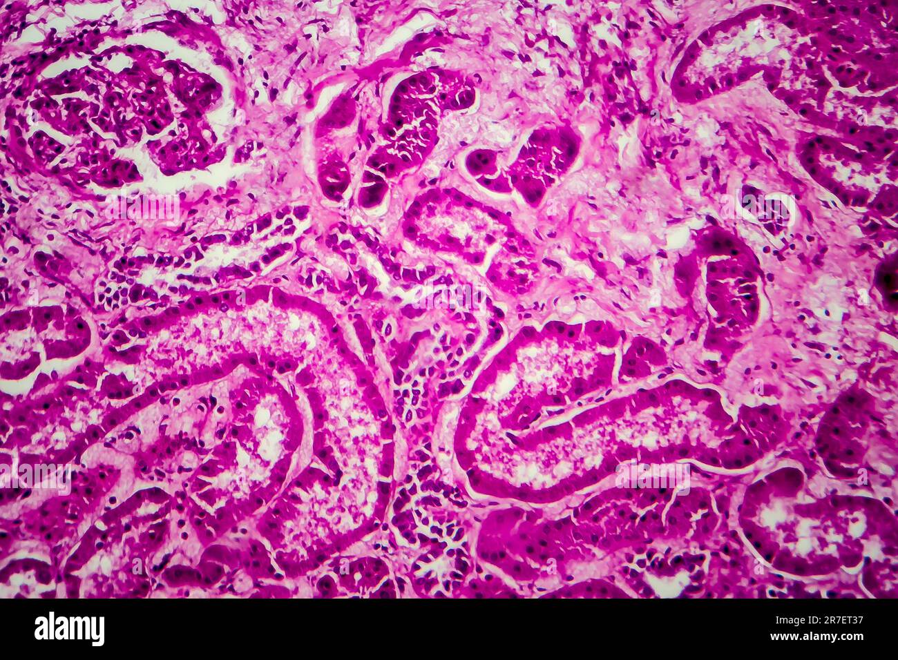 Glomerulonephritis. Light micrograph of tissue from a kidney in a case ...