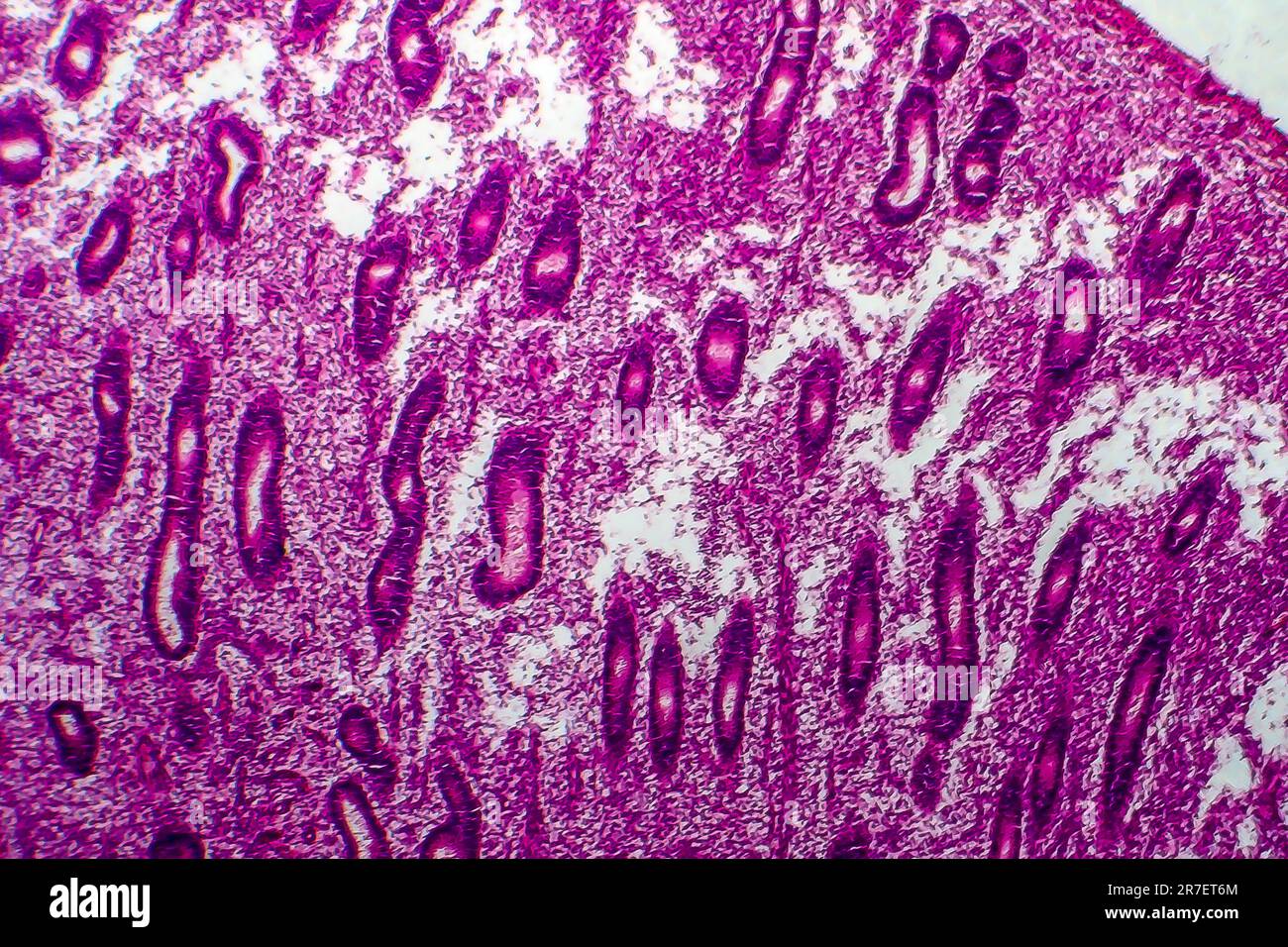 Endometrial hyperplasia. Light micrograph of a section through tissue ...