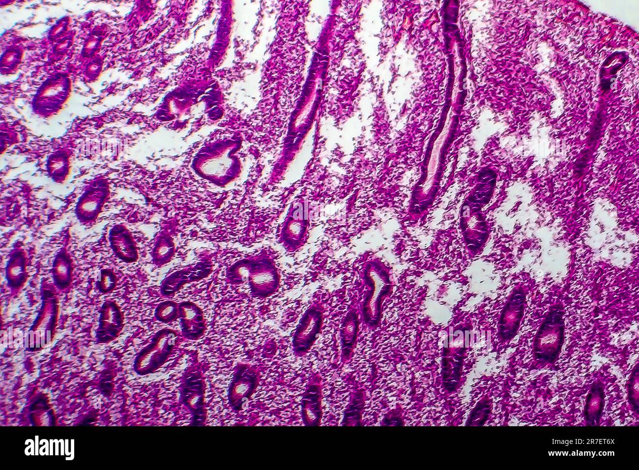 Endometrial hyperplasia. Light micrograph of a section through tissue ...