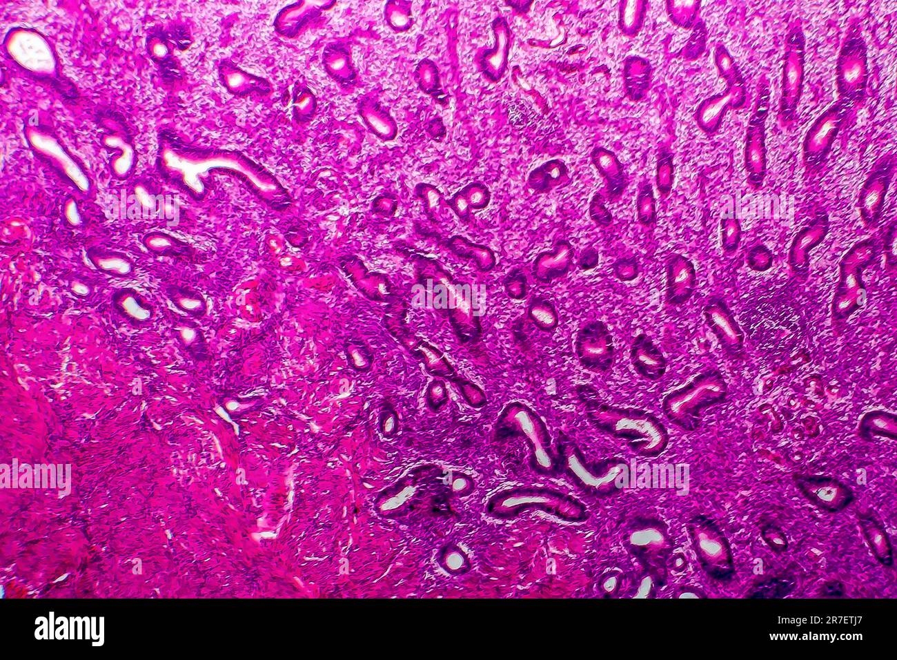 Endometrial hyperplasia. Light micrograph of a section through tissue ...