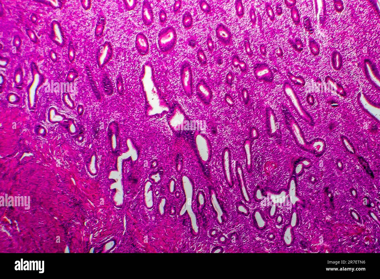 Endometrial hyperplasia. Light micrograph of a section through tissue ...