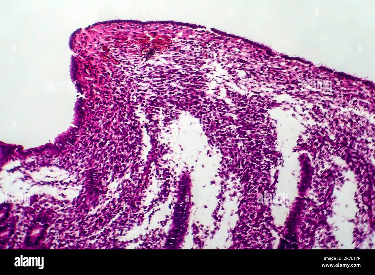 Endometrial hyperplasia. Light micrograph of a section through tissue ...