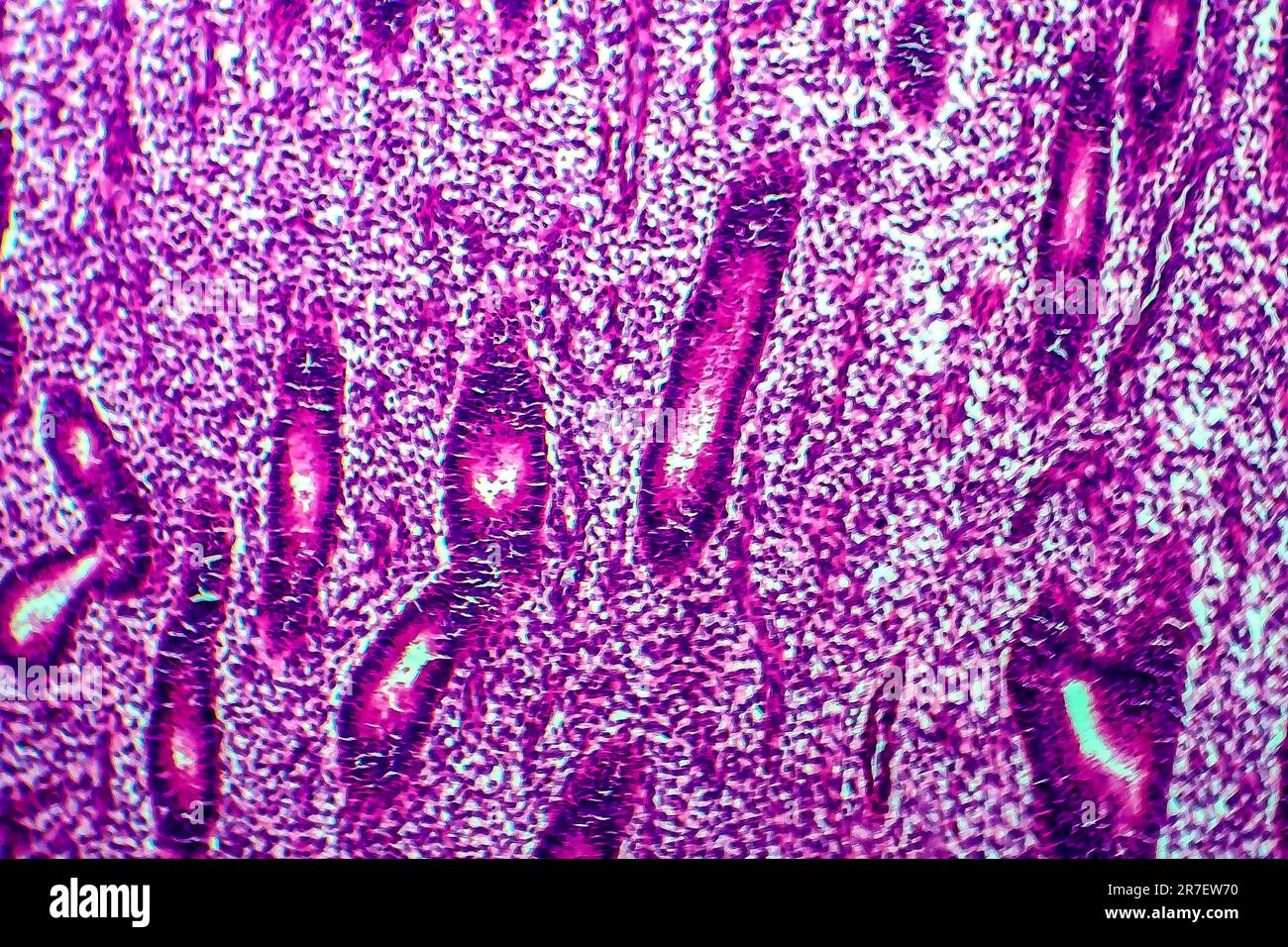 Endometrial hyperplasia. Light micrograph of a section through tissue ...