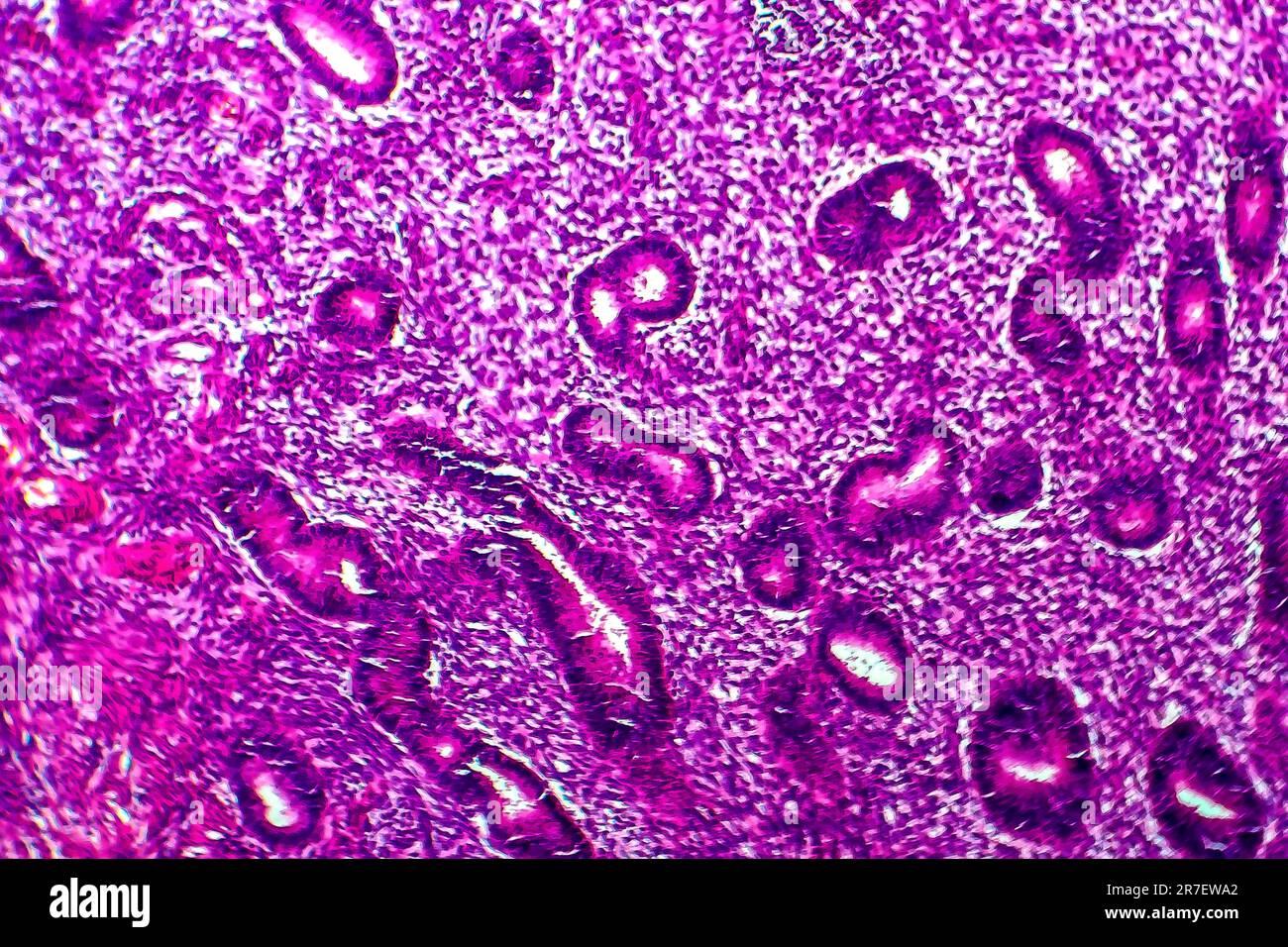 Endometrial hyperplasia. Light micrograph of a section through tissue ...