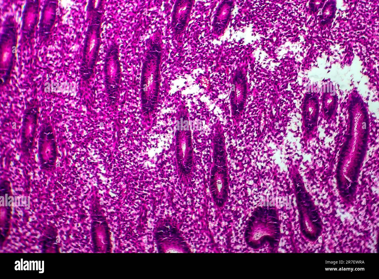 Endometrial hyperplasia. Light micrograph of a section through tissue ...