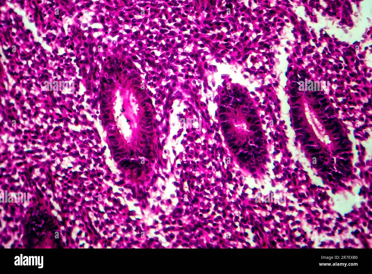 Endometrial hyperplasia. Light micrograph of a section through tissue ...