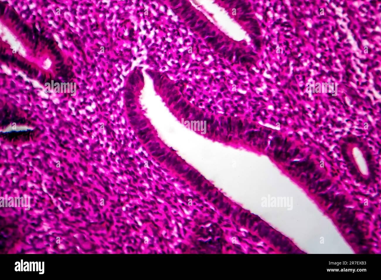 Endometrial hyperplasia. Light micrograph of a section through tissue ...