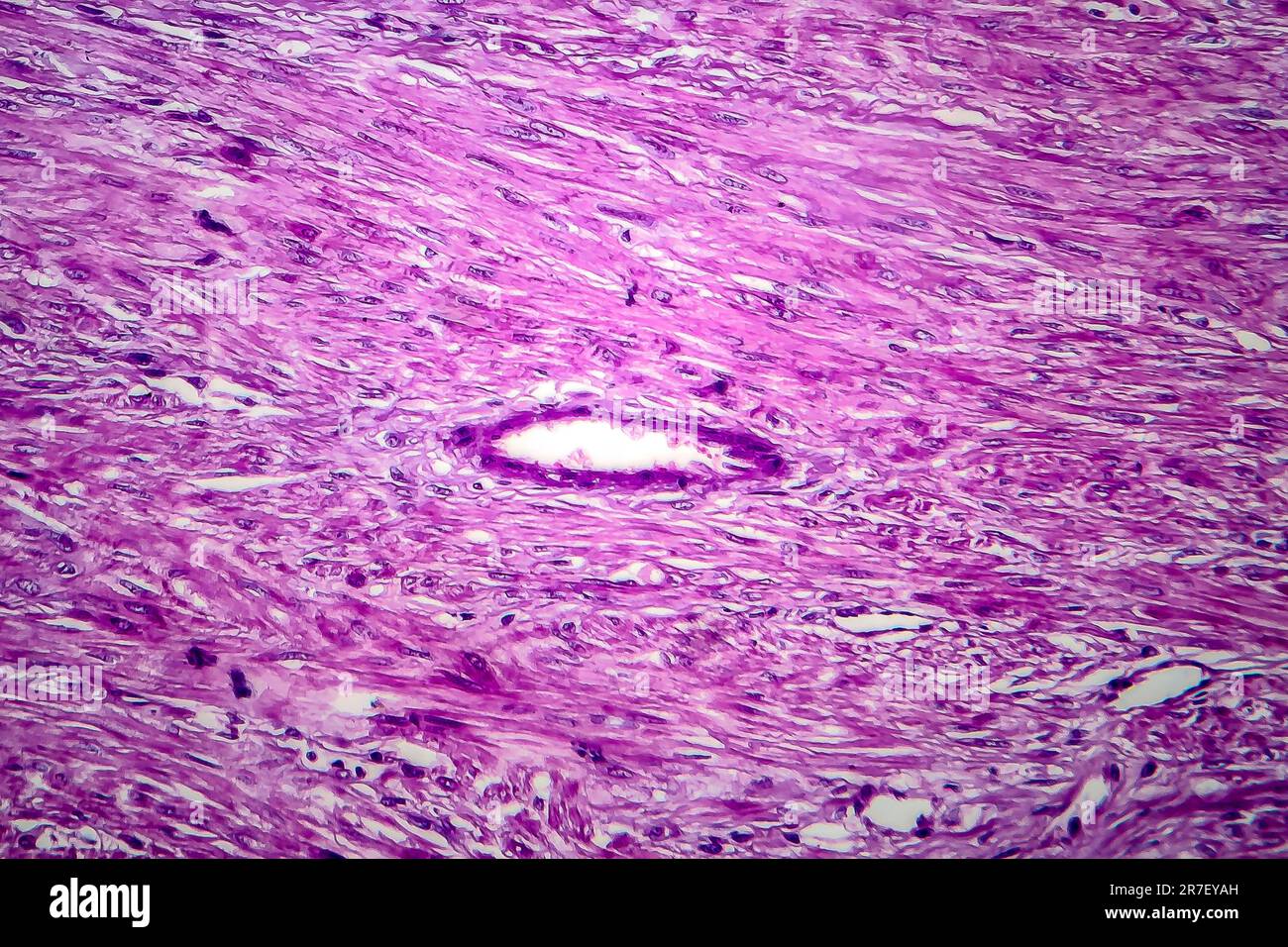 Uterine fibroid. Light micrograph (LM) of a section through tissue from ...
