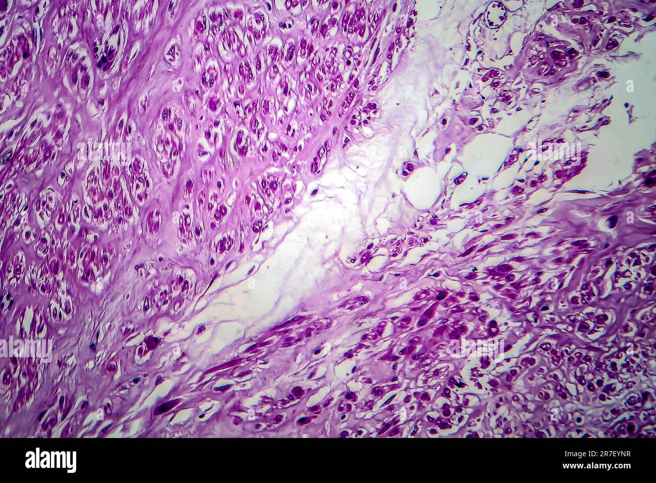Uterine fibroid. Light micrograph (LM) of a section through tissue from ...
