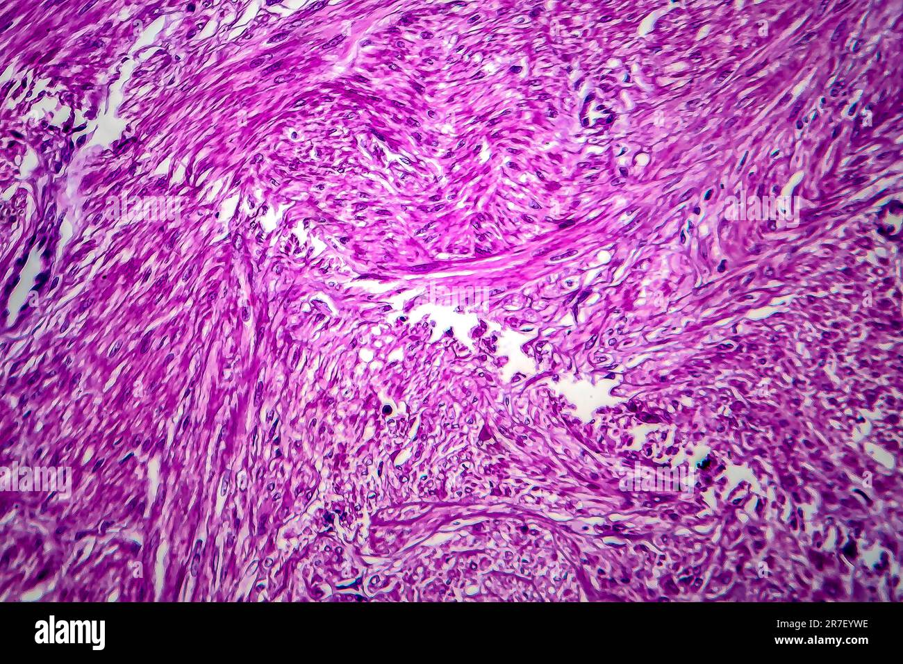 Tumour cells micrograph hi-res stock photography and images - Alamy