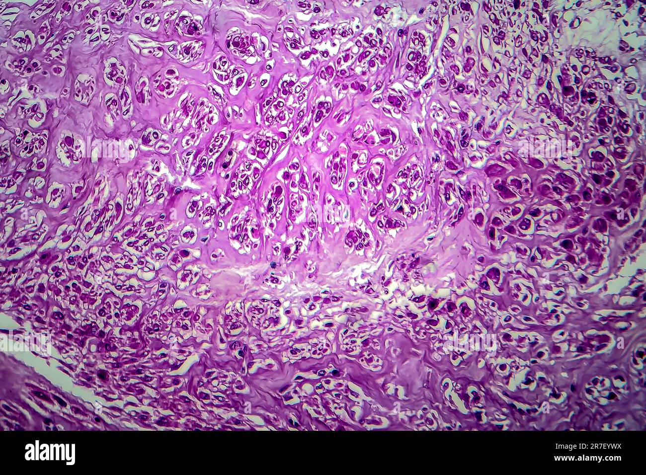 Uterine fibroid. Light micrograph (LM) of a section through tissue from ...