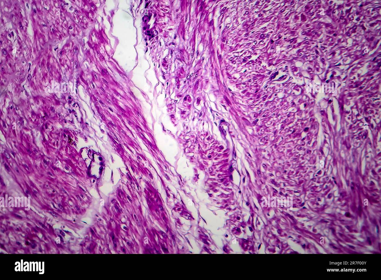Uterine fibroid. Light micrograph (LM) of a section through tissue from ...