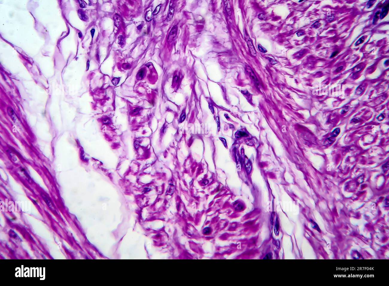 Uterine fibroid. Light micrograph (LM) of a section through tissue from ...