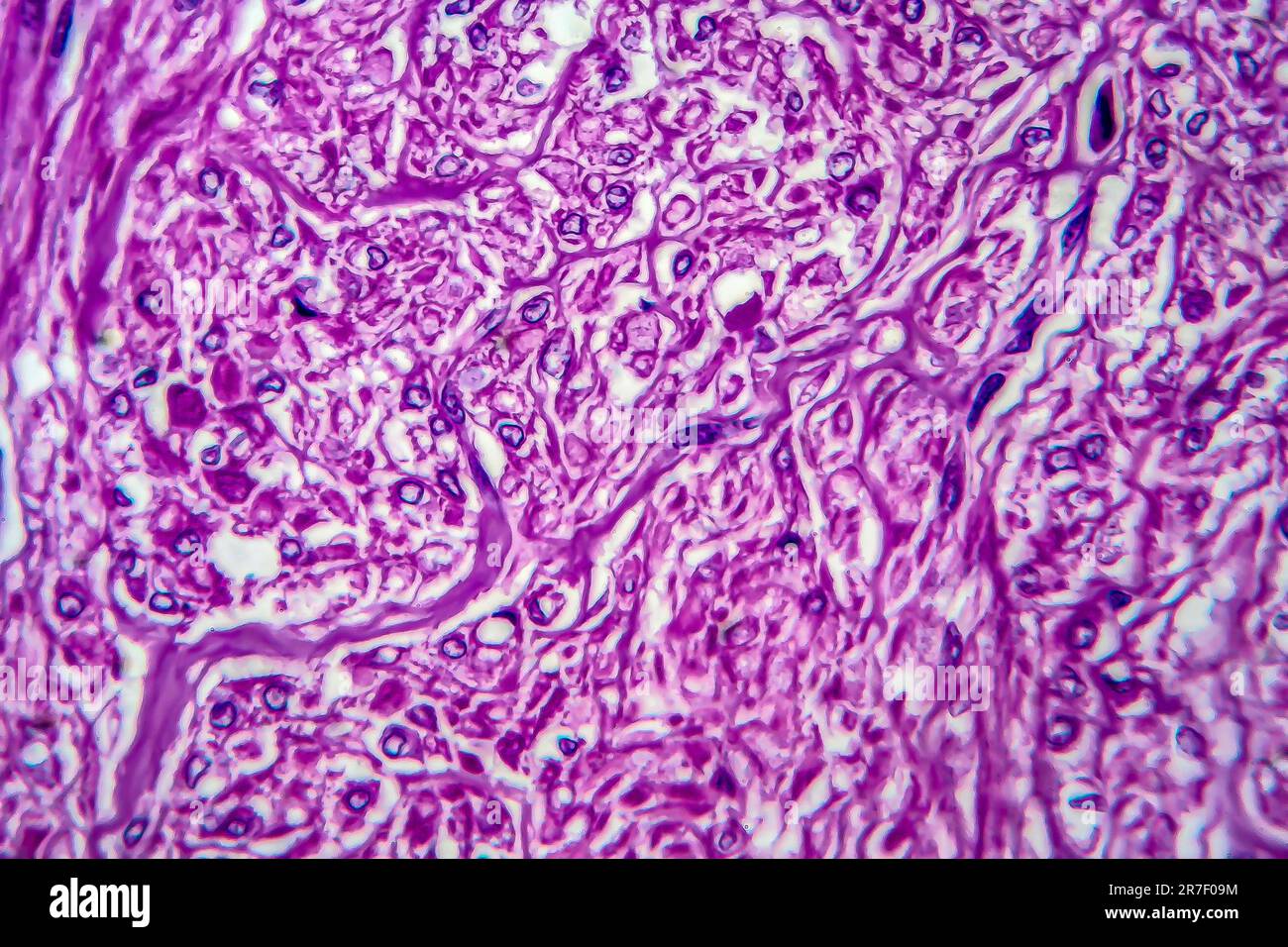 Uterine fibroid. Light micrograph (LM) of a section through tissue from ...