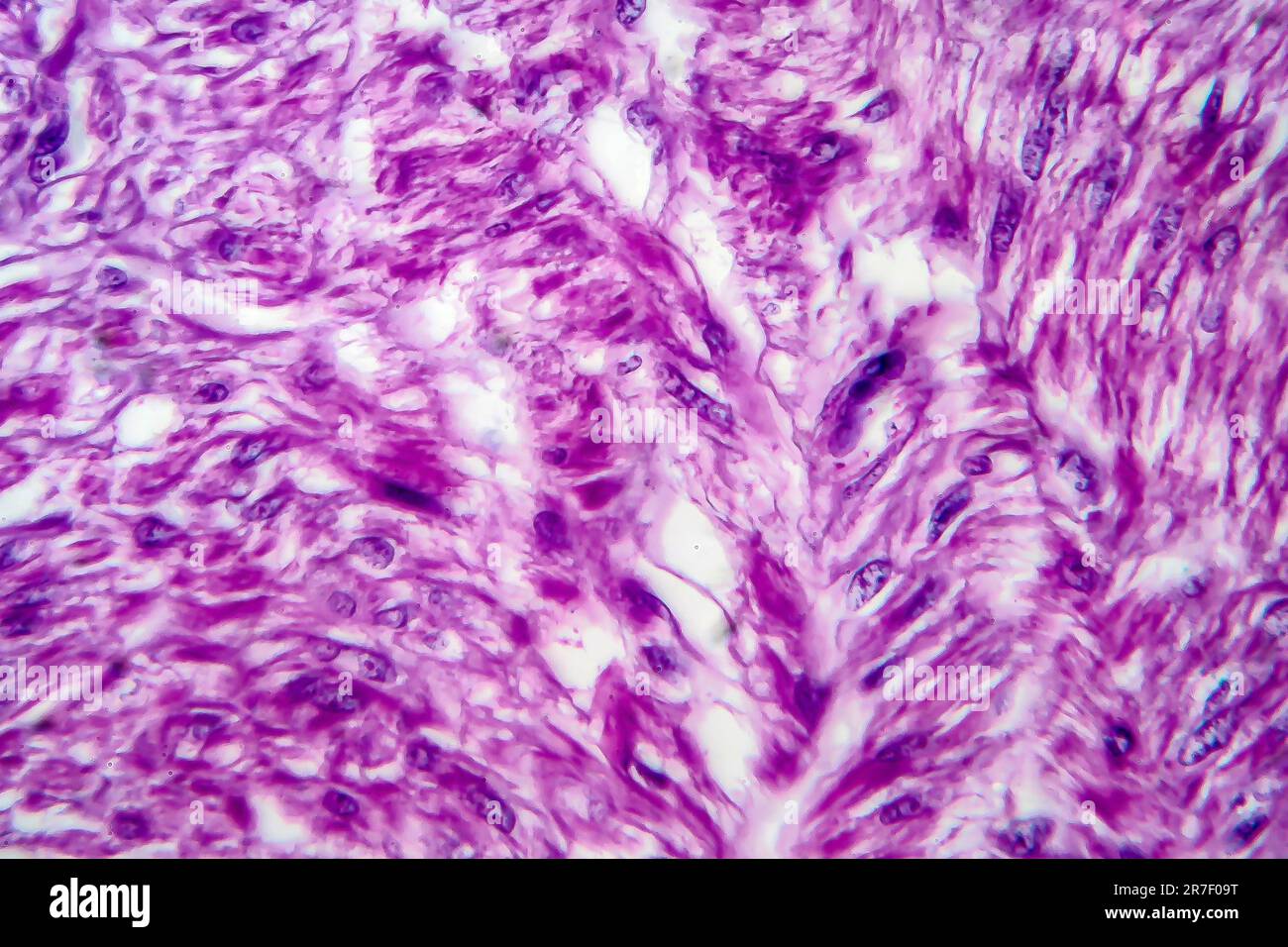Uterine fibroid. Light micrograph (LM) of a section through tissue from ...