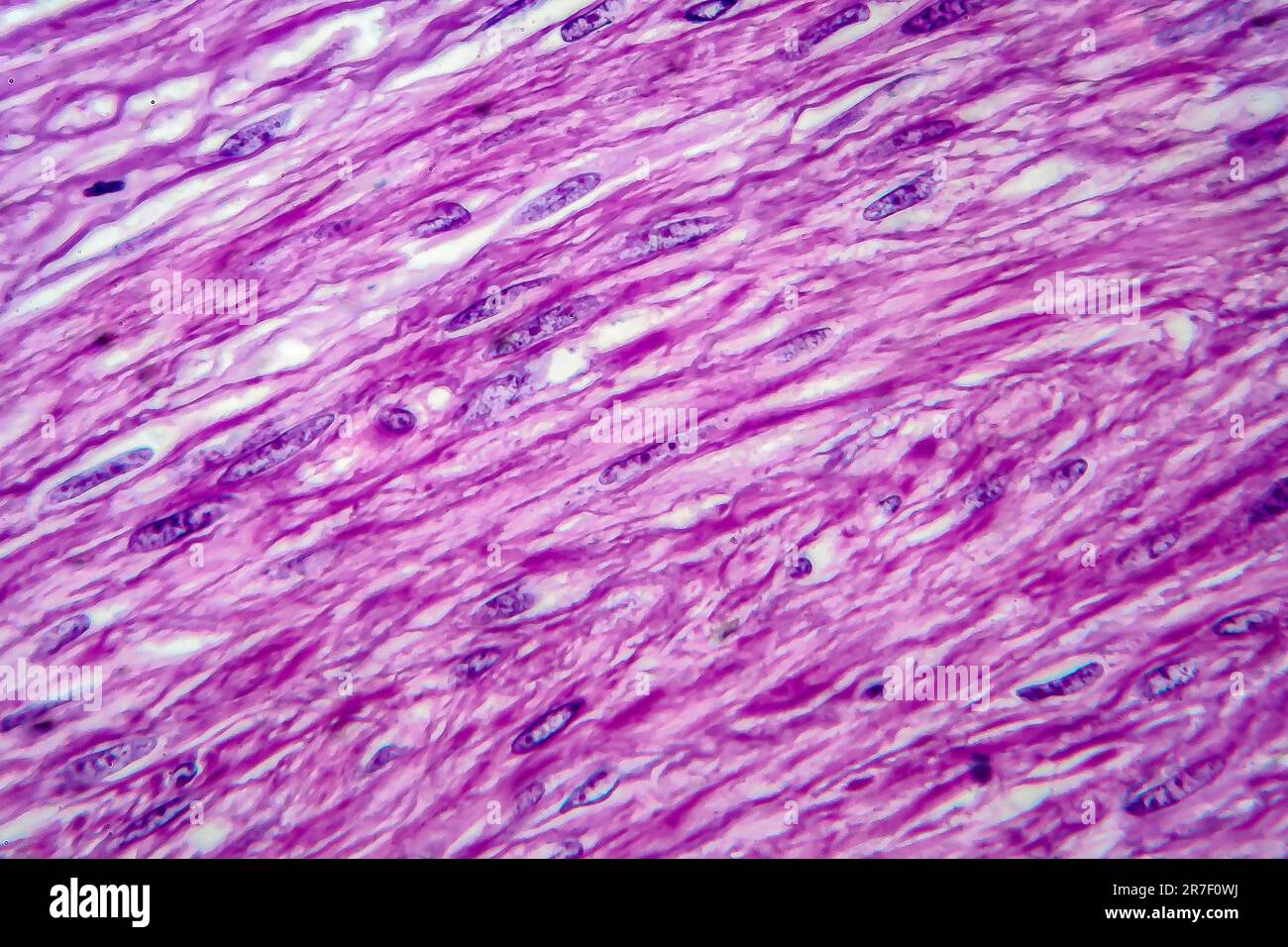 Uterine Fibroid Light Micrograph Lm Of A Section Through Tissue From