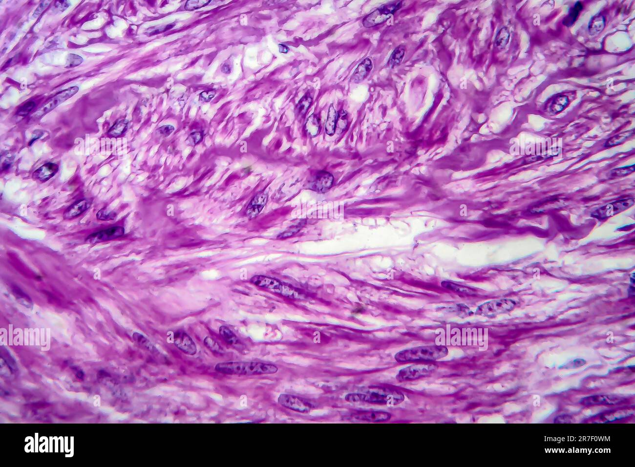 Uterine fibroid. Light micrograph (LM) of a section through tissue from ...