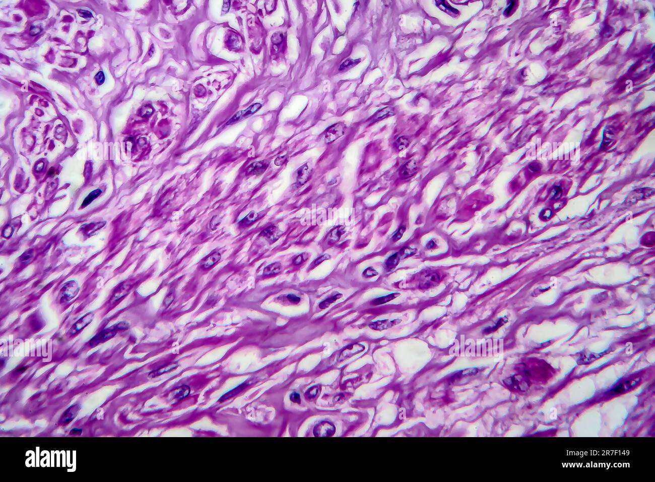 Uterine fibroid. Light micrograph (LM) of a section through tissue from ...