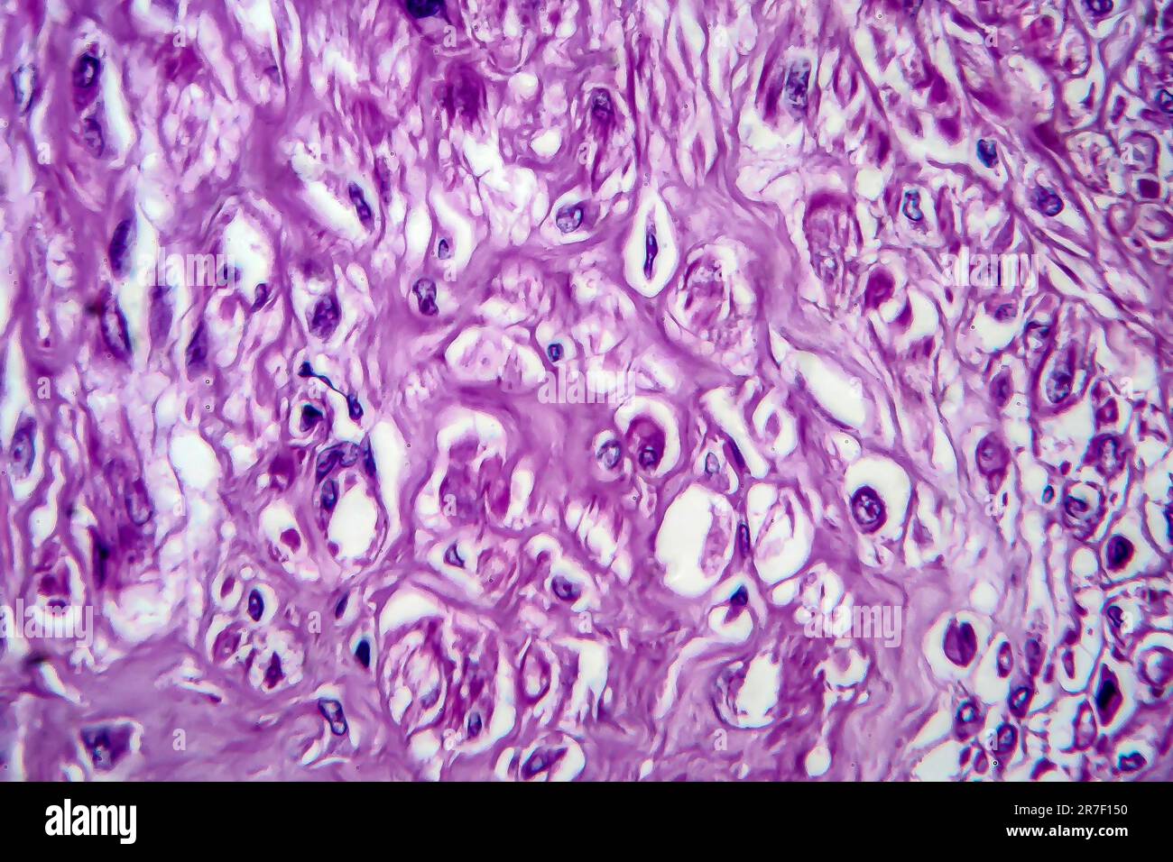 Uterine fibroid. Light micrograph (LM) of a section through tissue from ...