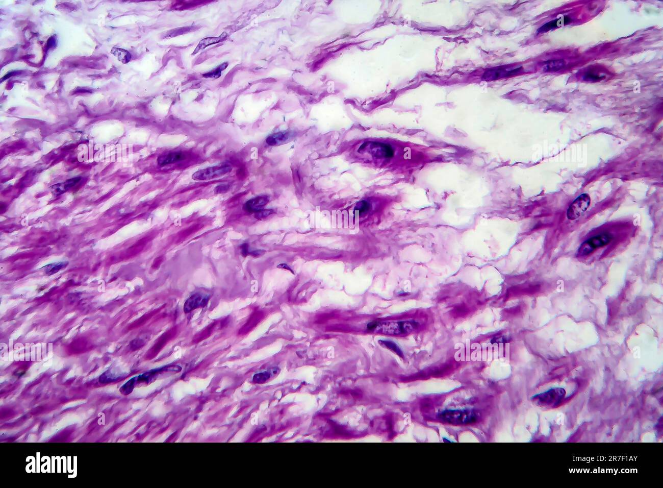 Uterine fibroid. Light micrograph (LM) of a section through tissue from ...