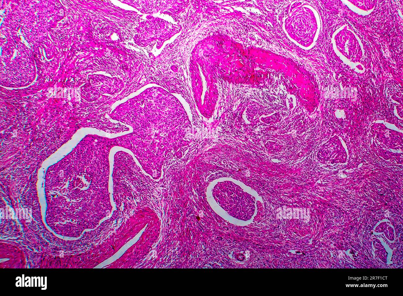 Cervical cancer. Light micrograph (LM) of a section through a squamous ...