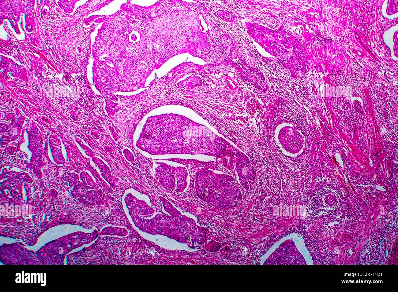Cervical cancer. Light micrograph (LM) of a section through a squamous ...