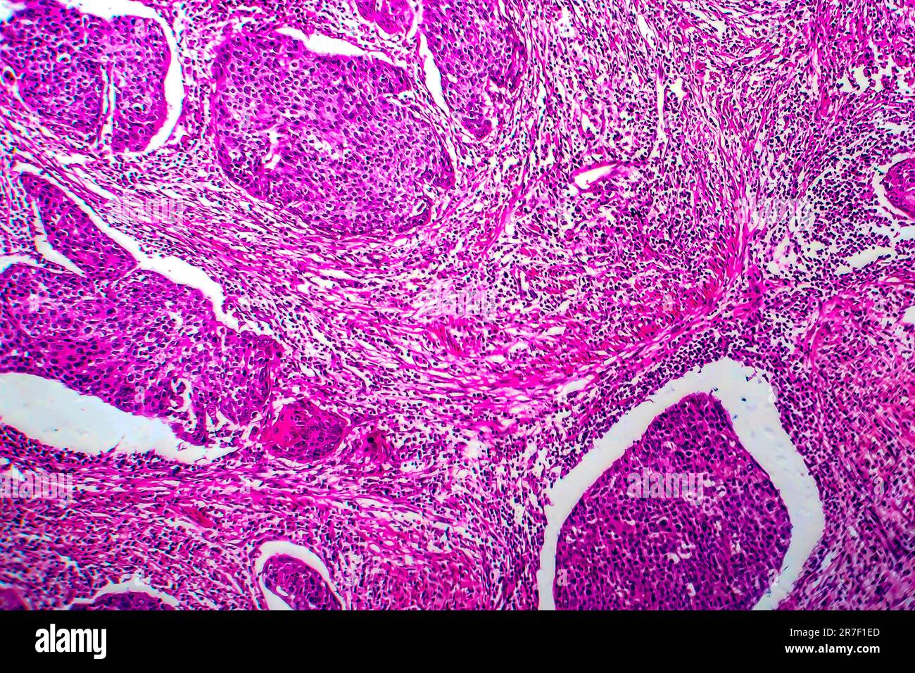 Cervical cancer. Light micrograph (LM) of a section through a squamous ...
