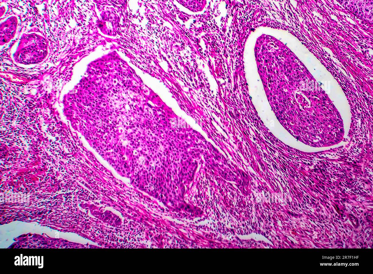 Cervical cancer. Light micrograph (LM) of a section through a squamous ...