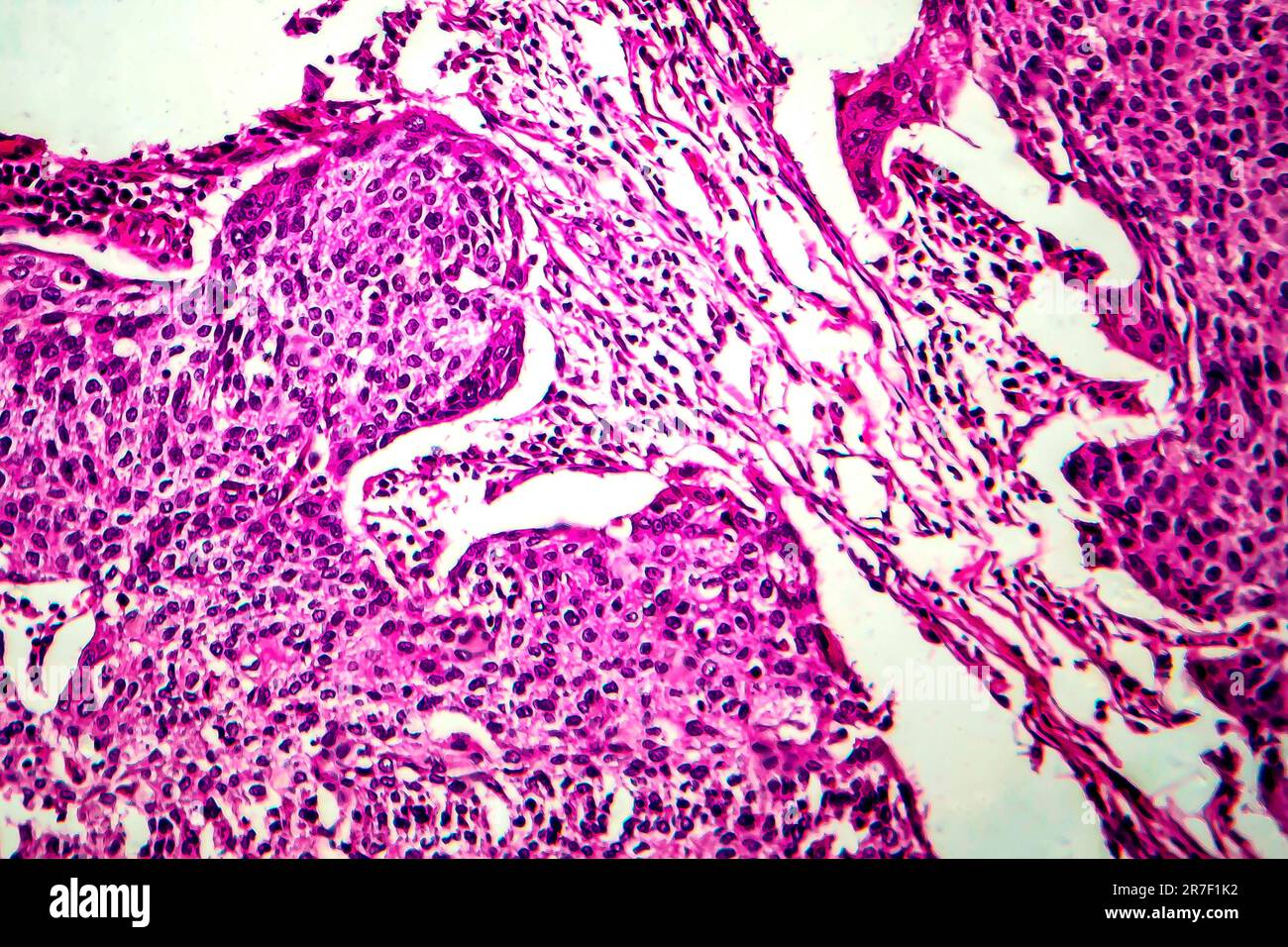 Cervical cancer. Light micrograph (LM) of a section through a squamous ...