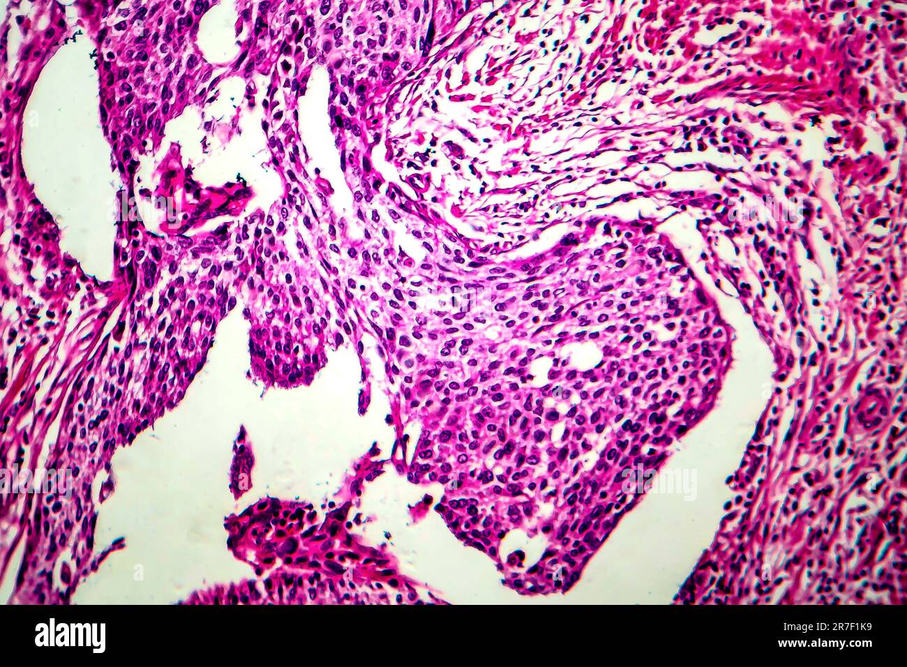 Cervical Cancer Light Micrograph Lm Of A Section Through A Squamous Cell Carcinoma Of The