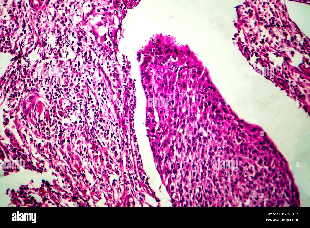 Cervical cancer. Light micrograph (LM) of a section through a squamous ...