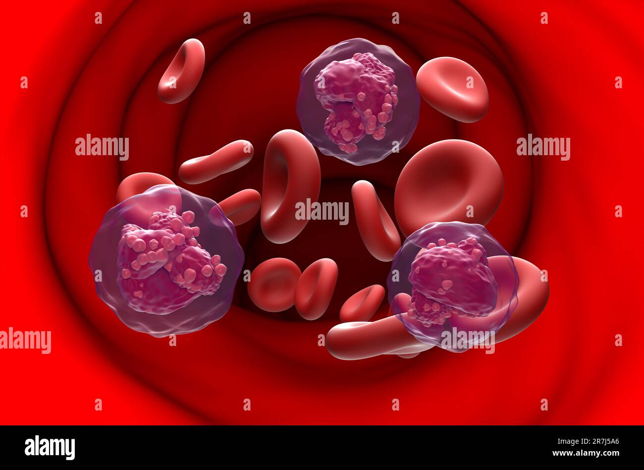 Acute lymphoblastic leukemia (ALL) cancer cell in blood flow - section ...