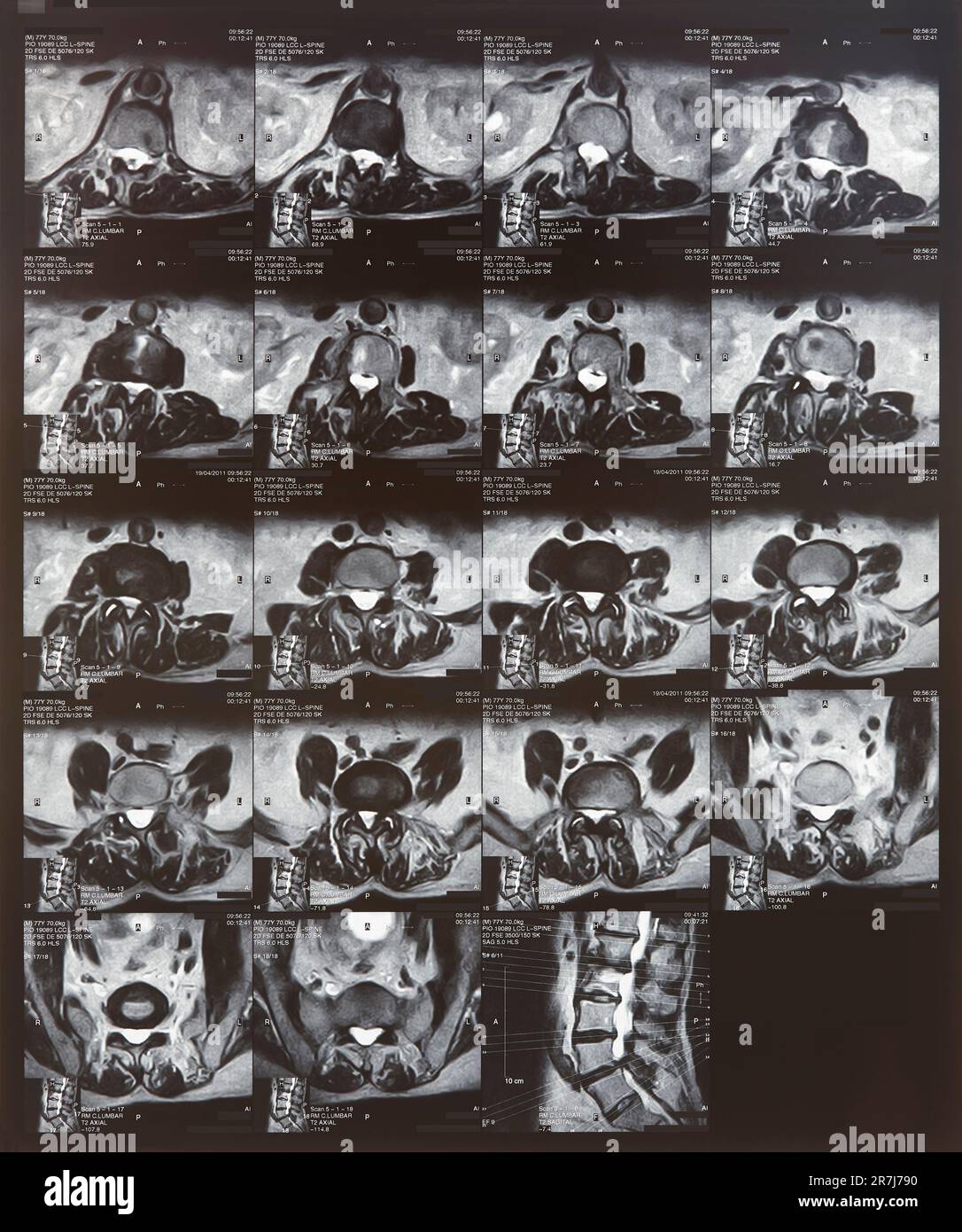 Magnetic resonance imaging. Spinal column detail. Medical procedure ...